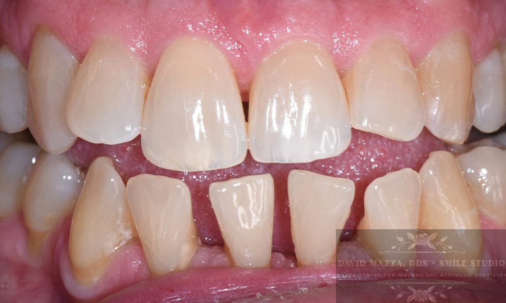 Invisalign Smile Gallery: Prior-Enhanced Transformation - Dentist ...